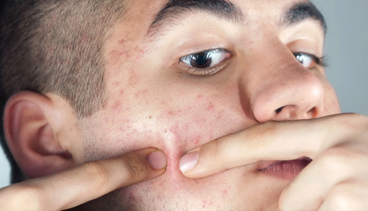 5 Major Causes of Acne in Men - lifeberrys.com