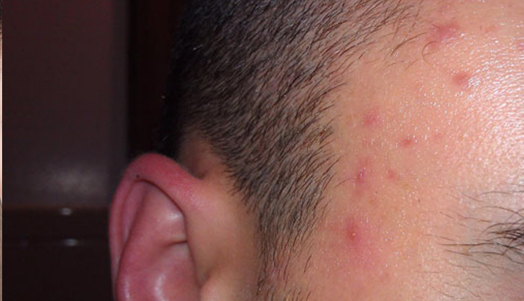 6 Effective Home Remedies To Cure Heat Boils on Face - lifeberrys.com