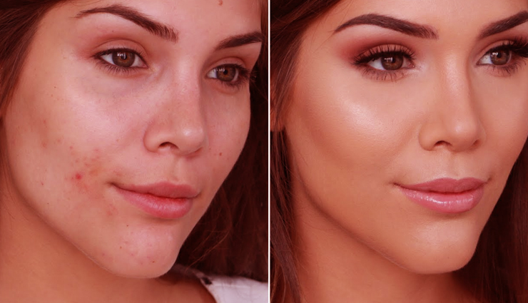 10 Ways To Cover Your Acne Using Makeup - lifeberrys.com