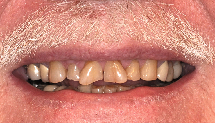 Causes of Yellow Teeth and 8 Effective Home Remedies to Whiten Them ...