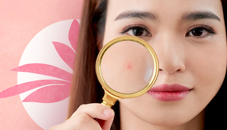 What are Blind Pimples and How To Get Rid of Them - lifeberrys.com