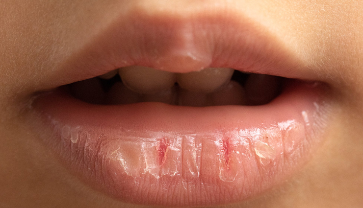 6 Quick Home Remedies To Treat Cracked Lips - lifeberrys.com
