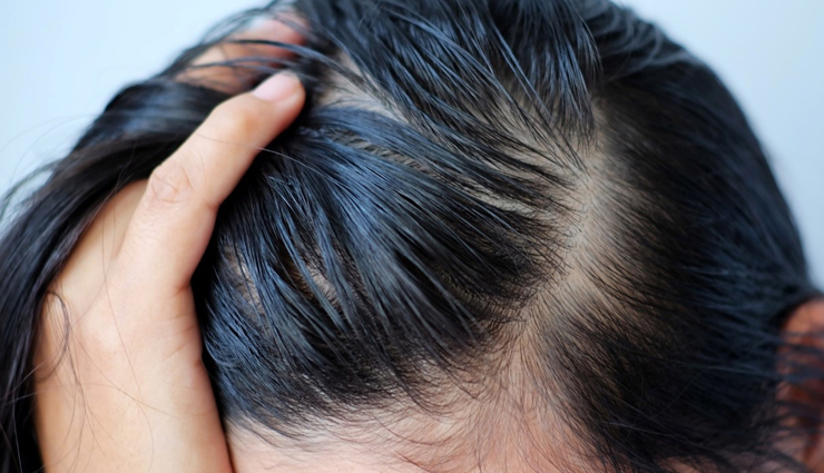 5 Major Reasons That Possibly Be Causing Dandruff