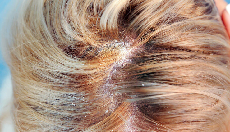 5 Major Reasons That Possibly Be Causing Dandruff