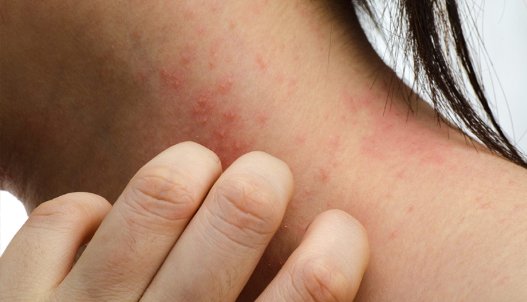 5 Most Common Types of Rashes and How To Manage Them - lifeberrys.com