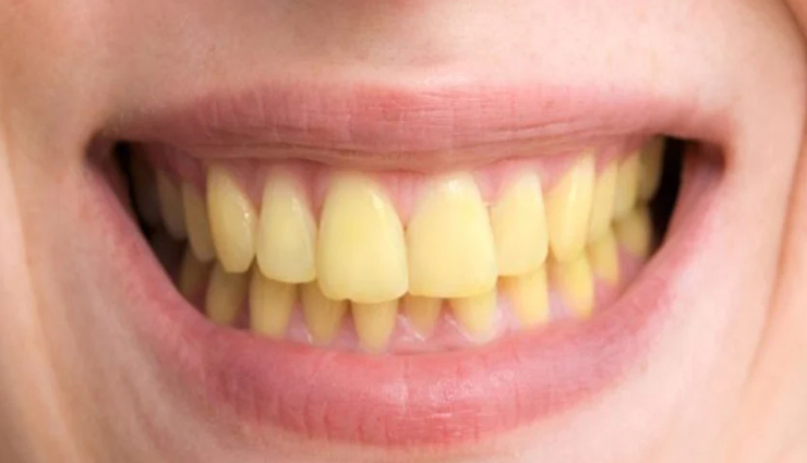 Causes of Yellow Teeth and 8 Effective Home Remedies to Whiten Them ...