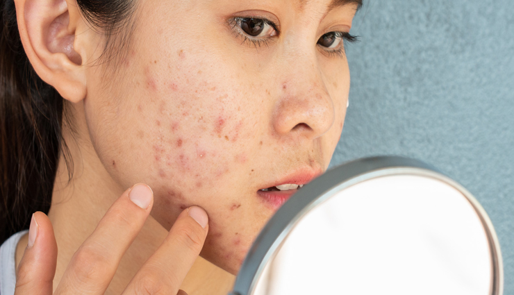 5 Home Remedies To Remove Pimples Overnight - lifeberrys.com