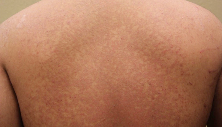 6 Reasons That Might Cause White Spots on Your Skin - lifeberrys.com