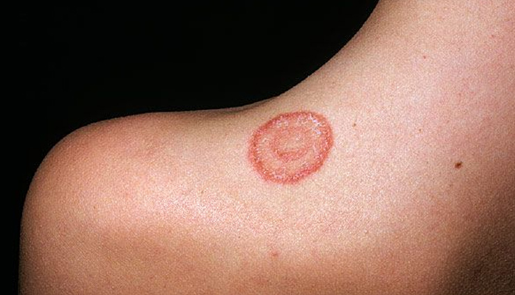 5 Skin Conditions That Look Like Eczema - lifeberrys.com