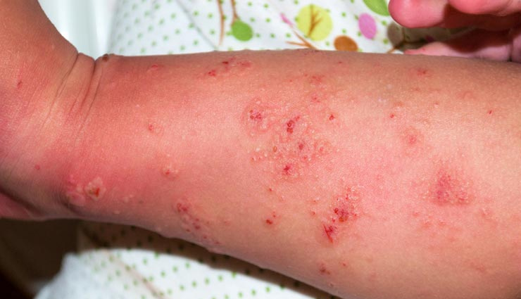 5 Skin Conditions That Look Like Eczema - lifeberrys.com