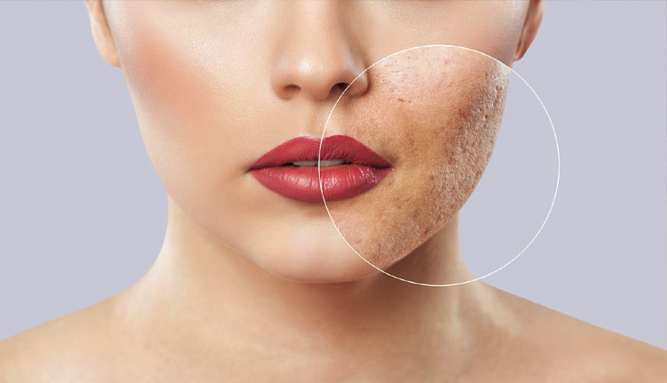 9 Remedies To Heal and Lighten Scars - lifeberrys.com