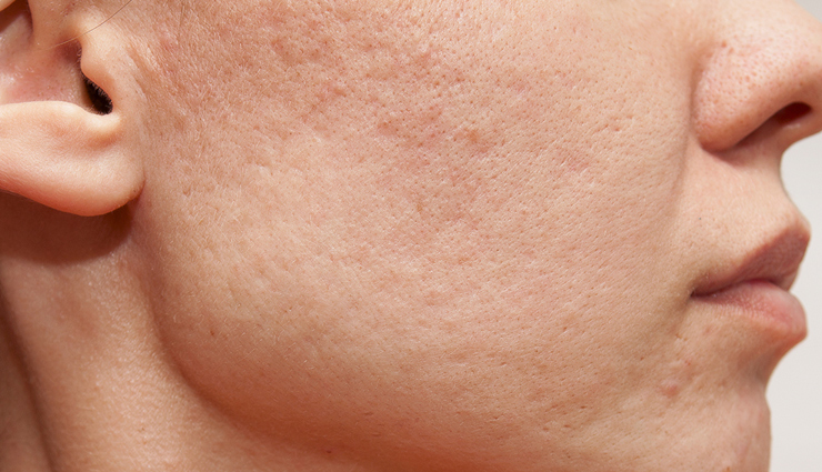 6 Ways To Use Lemon To Treat Scars and Marks - lifeberrys.com