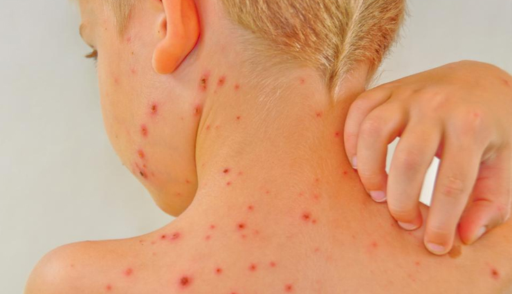 7 Home Remedies That are Beneficial for Chickenpox Treatment ...