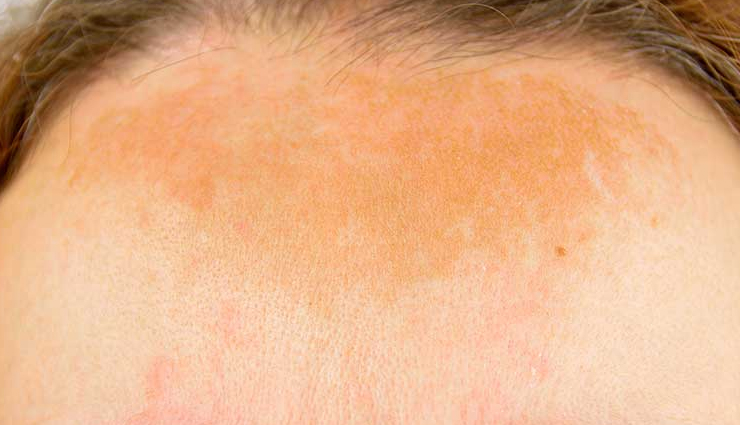 Major Causes and Prevention Tips for Skin Darkening - lifeberrys.com