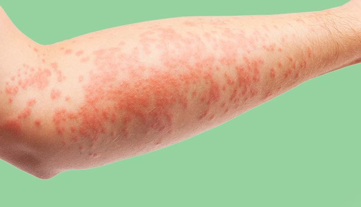 5 Types of Skin Disorder That Leave Permanent Effect - lifeberrys.com