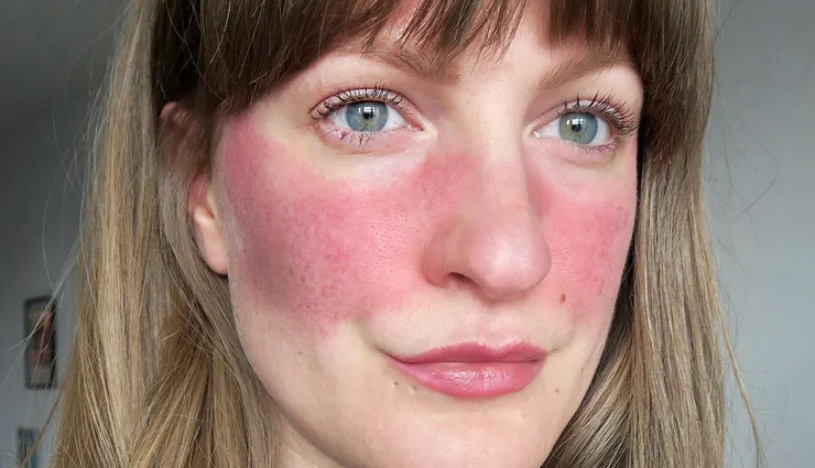 5 Types of Skin Disorder That Leave Permanent Effect - lifeberrys.com