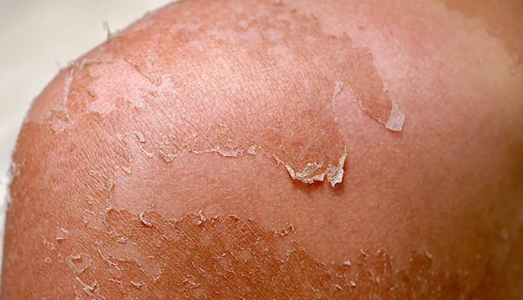 Home Remedies To Treat Peeling Skin - lifeberrys.com