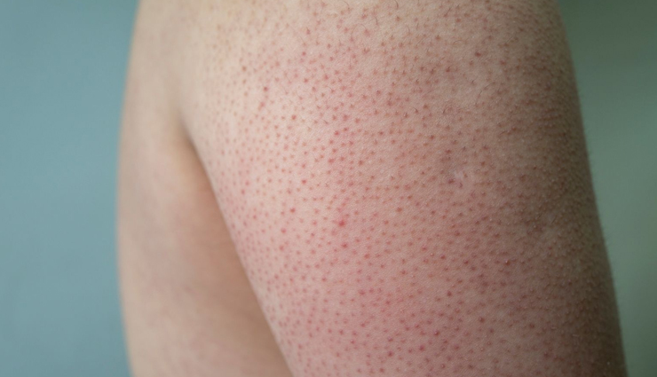 5 Must Try Home Remedies To Treat Strawberry Skin - lifeberrys.com