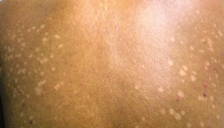 6 Reasons That Might Cause White Spots on Your Skin - lifeberrys.com