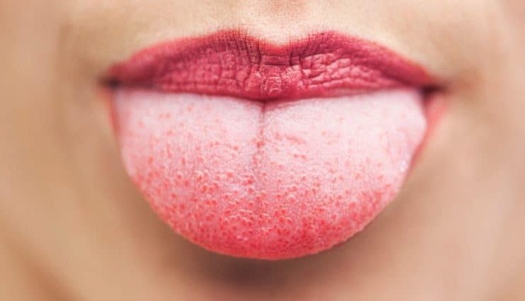 Here is What The Color of Your Tongue Say About Your Health ...
