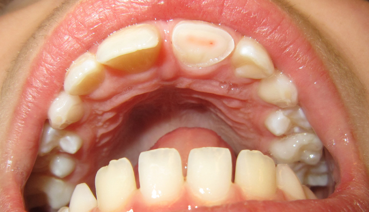 Causes of Yellow Teeth and 8 Effective Home Remedies to Whiten Them ...