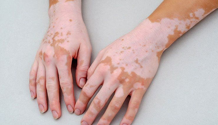 6 Reasons That Might Cause White Spots on Your Skin - lifeberrys.com