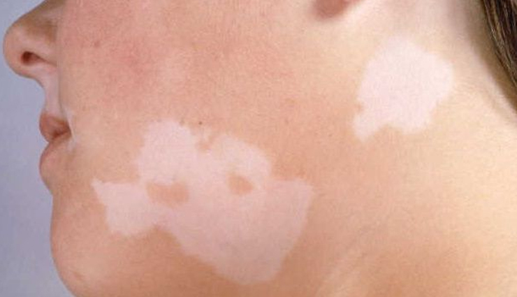 6 Reasons That Might Cause White Spots on Your Skin - lifeberrys.com
