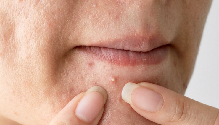 7 Home Remedies To Help You Get Rid of Whiteheads - lifeberrys.com